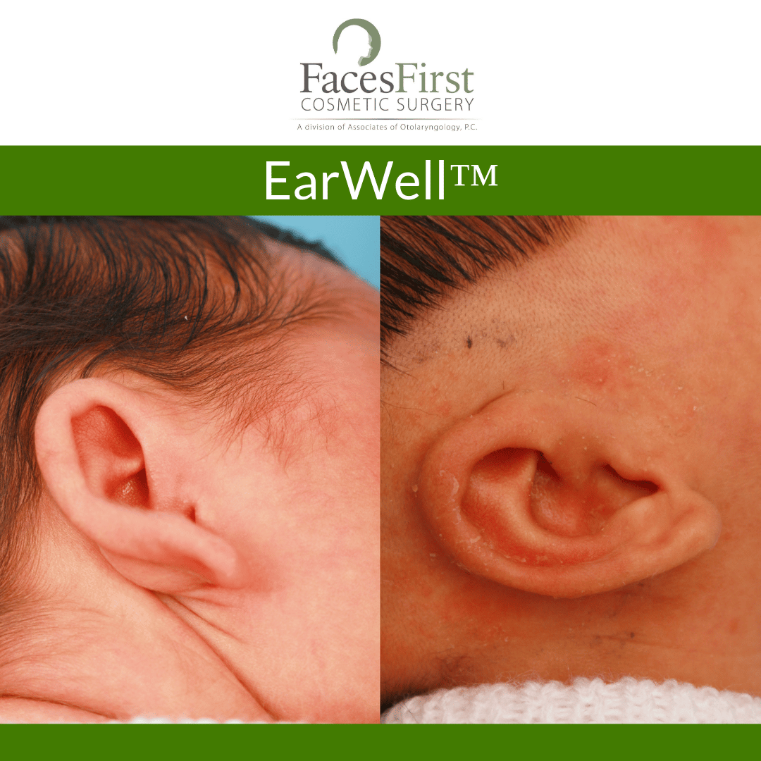 EarWell Infant Ear Correction in Denver, Lone Tree & Castle Rock, CO ...